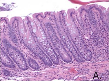 Proliferative ileitis and typhlitis – College of Veterinary Medicine